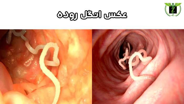 علائم انگلها در بزرگسالان و کودکان چیست؟ + انواع انگل - کلینیک مهنا